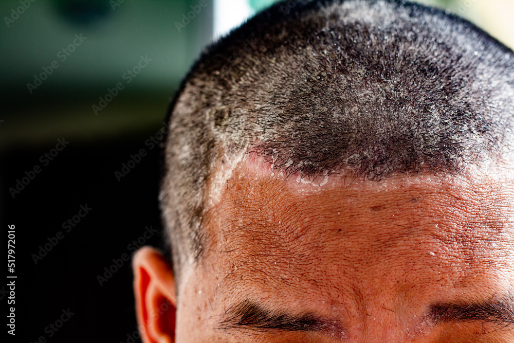 skin disease at the head, Dandruff is a common condition that causes ...
