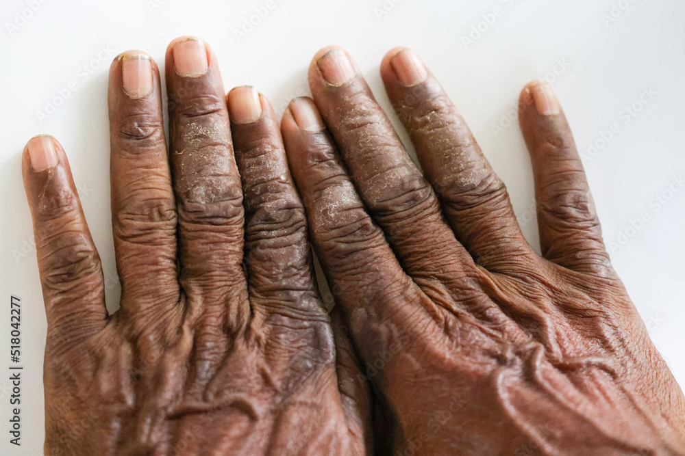 Pattern of Atopic eczema and fungal diseases on the human body. Stock ...