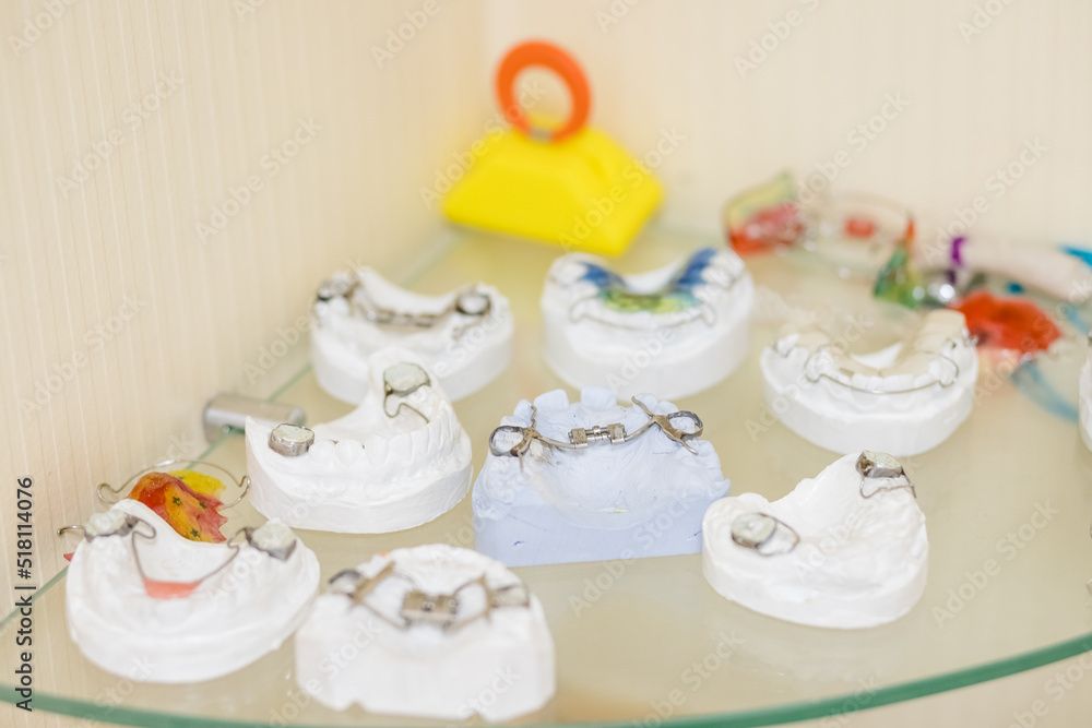 models of Dental plate to align deformed teeth. unremovable orthodontic ...