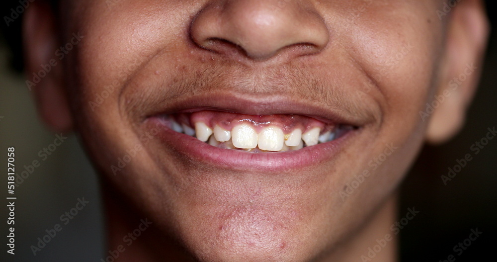 Pre-teen young boy smiling, close-up child mouth teeth Stock Photo ...