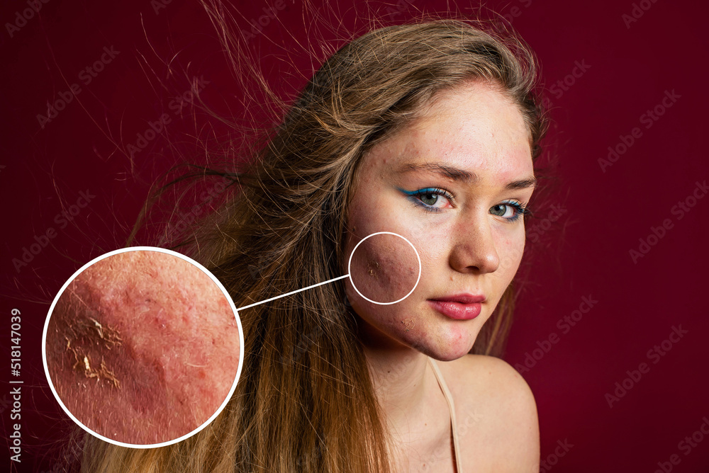 Beautiful model girl woman with allergy on her face. Red background ...