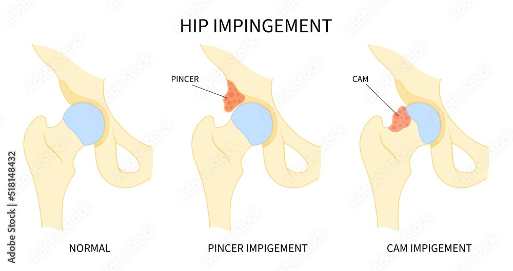 Impigement syndrome of hip bone Pain range of motion with head tear ...