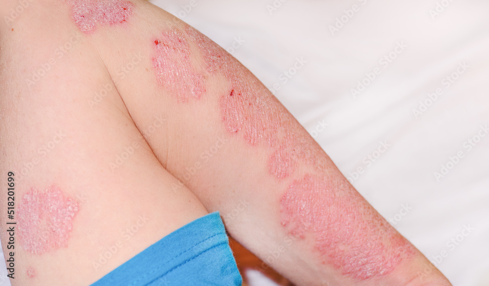 Acute psoriasis on the arm of a man, severe redness on the skin, an ...