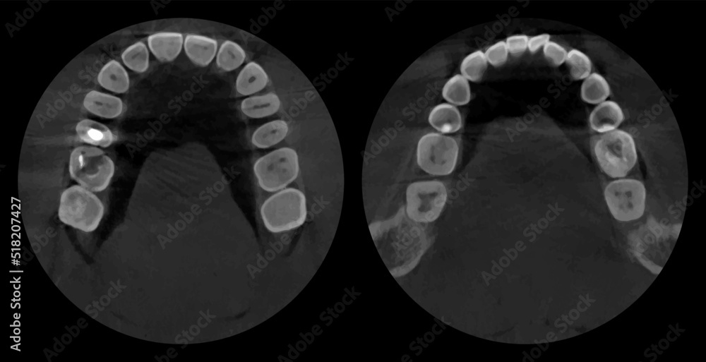 Teeth, realistic 3D scan jaw, dental MRI with caries, scanner picture ...