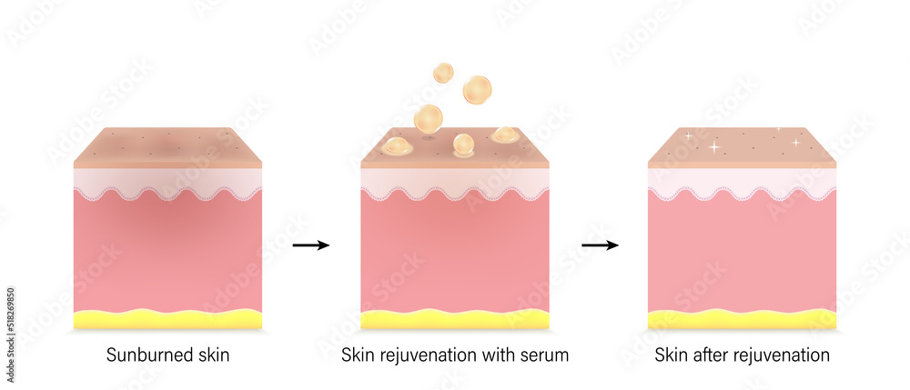 Skin layers before, during and after rejuvenation with skin serum. Skin ...