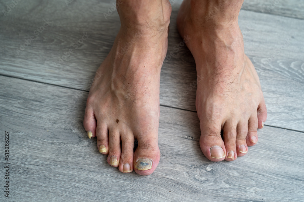 male man feet close up, nail fungus, skin and nail infection, toe ...