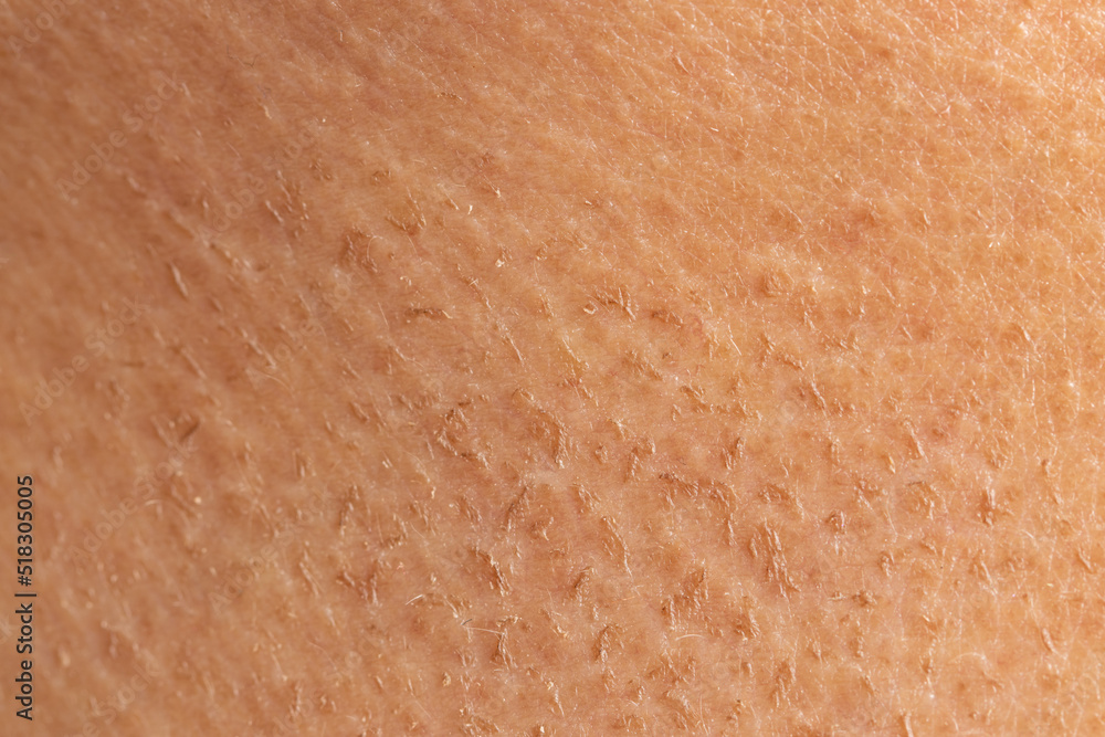 peeling of the skin after an allergic rash Stock Photo | Adobe Stock