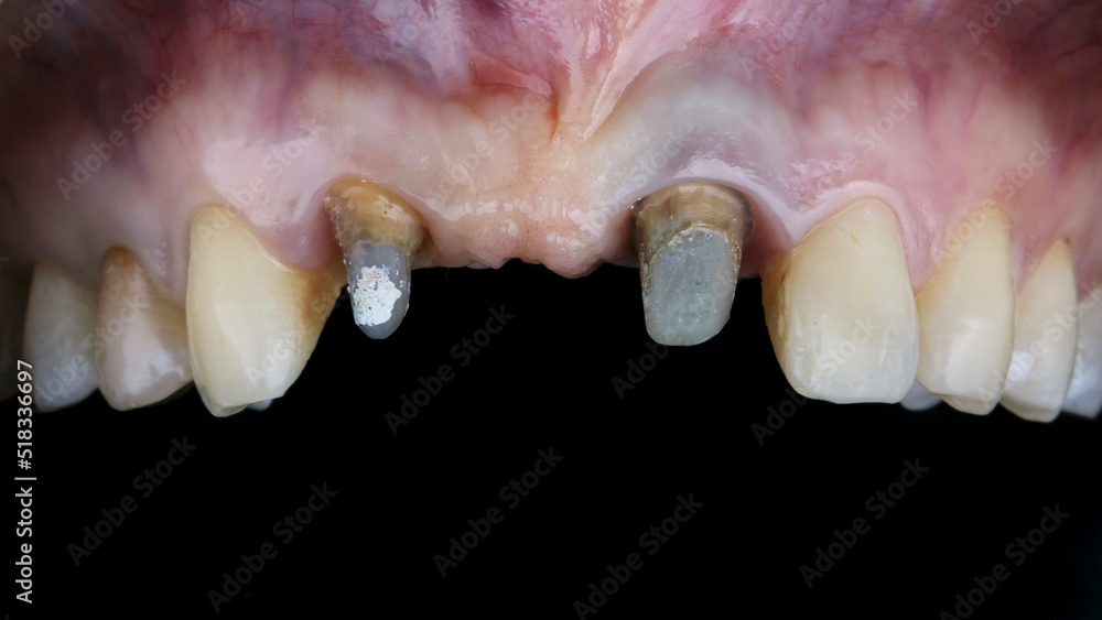 old prepared teeth without crowns before implantation in the area of ...