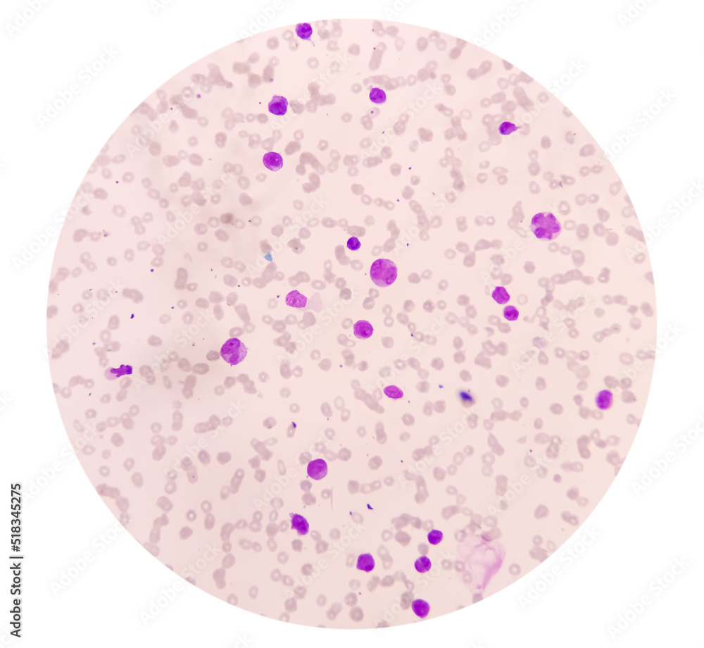 Chronic myeloid leukemia cells or CML, analyze by microscope, original ...