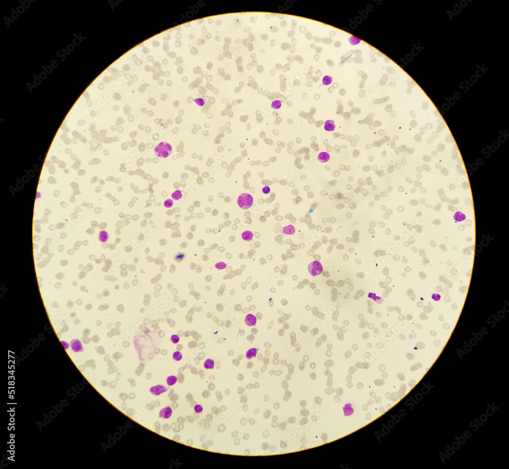 Chronic myeloid leukemia cells or CML, analyze by microscope, original ...