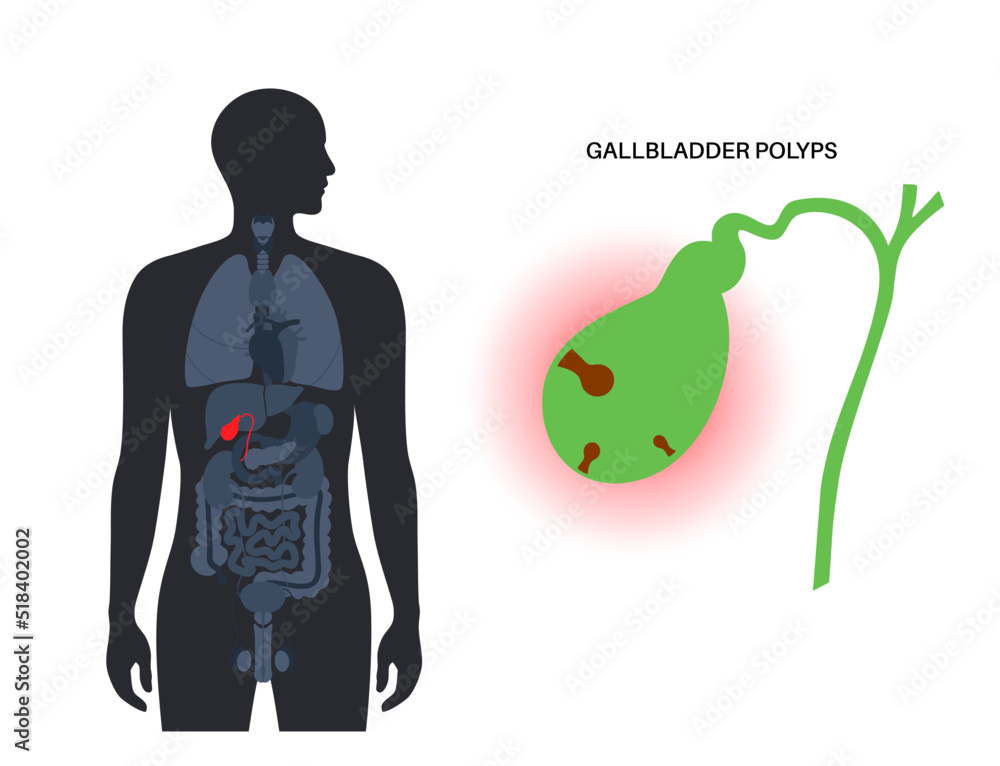 Gallbladder polyp anatomy Stock Vector | Adobe Stock