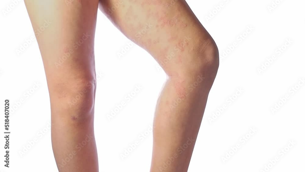 Video Stock Acute atopic dermatitis on the legs behind the knees of a ...