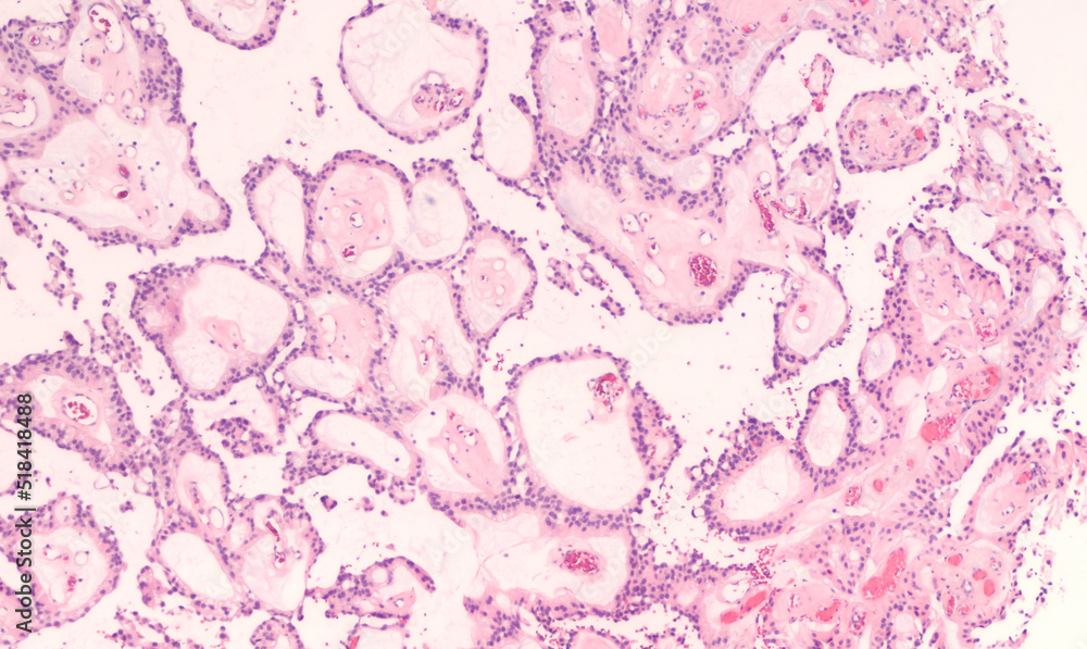 Myxopapillary Ependymoma: Ependymoma Grade 2 – VSZPG