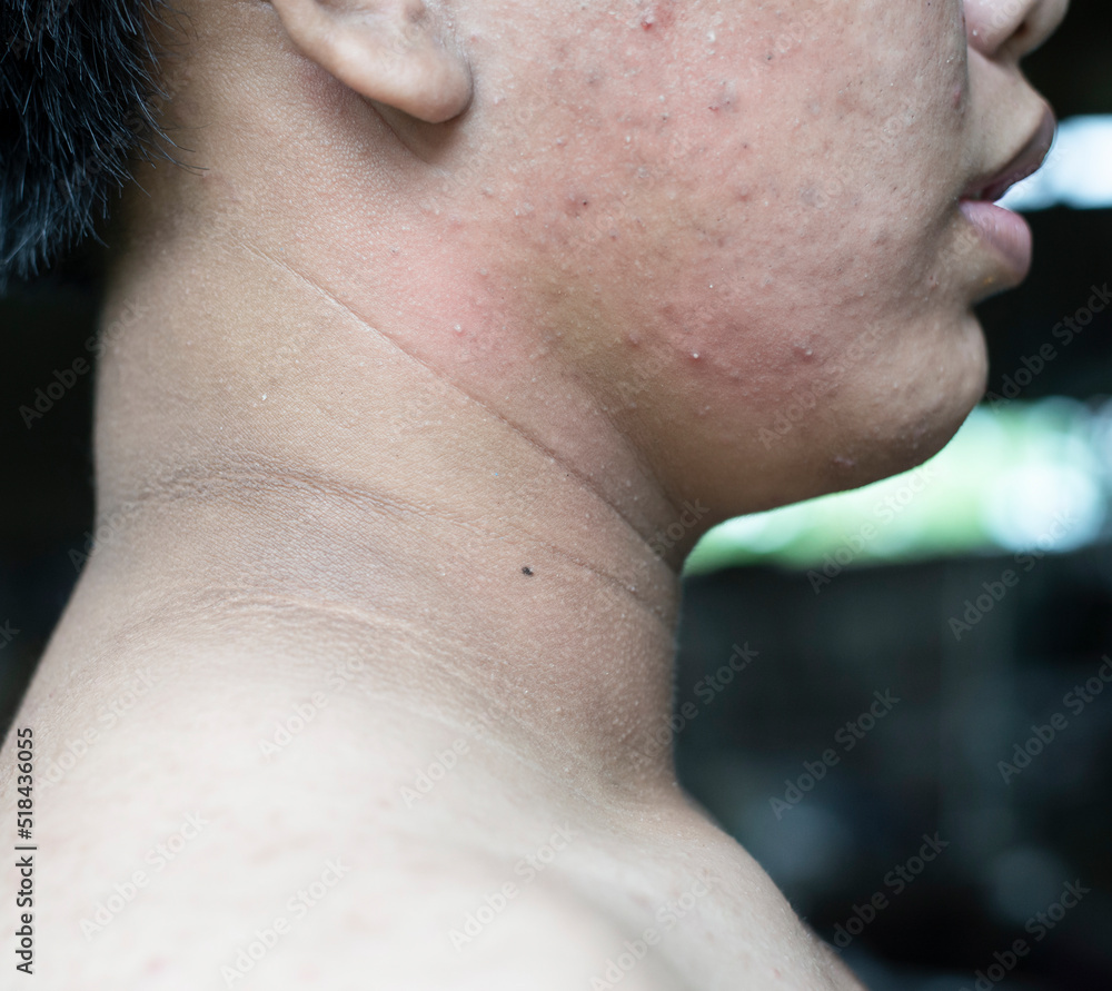 Inflammatory acne on the skin of a person's face and neck Stock Photo ...