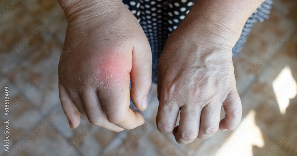 Close-up hand inflammation. Left hand was very swollen in region of the ...
