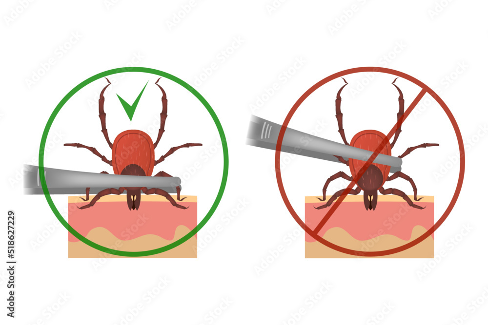 Infographic with correct and incorrect tick removal using tweezers ...
