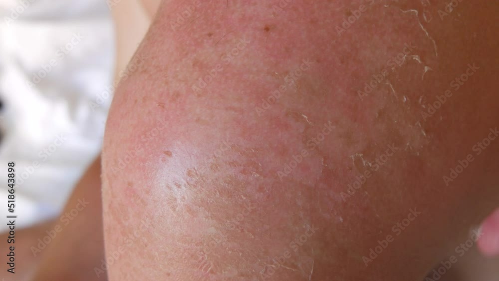 Sunburn: Closeup of Peeling sunburned skin on back and shoulder. Skin ...