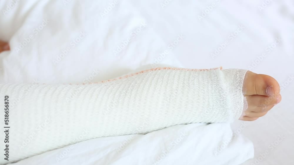 Vidéo Stock Children's leg in orthopedic plaster on a white bed in the ...
