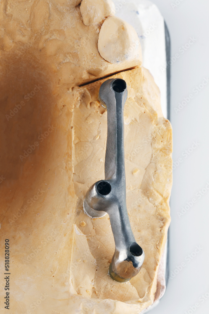titanium dental bar and plaster models Stock Photo | Adobe Stock