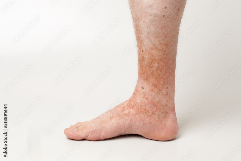 varicose veins of the legs Stock Photo | Adobe Stock