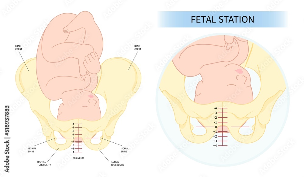 Vetor de Labor and C section fetal Baby born Head Down by praevia ...