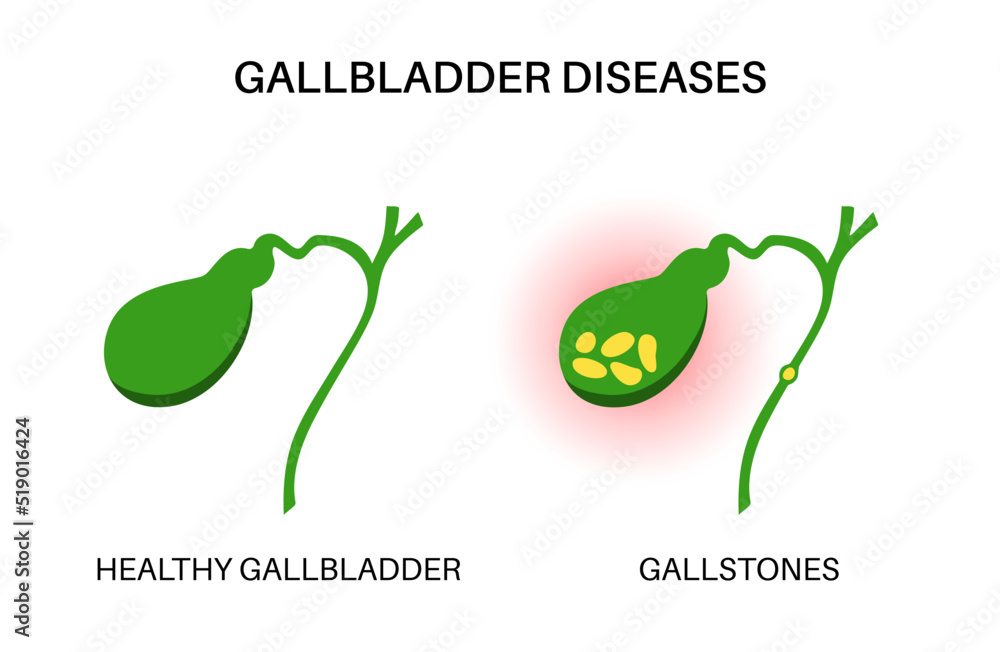 gallbladder anatomy poster Stock Vector | Adobe Stock