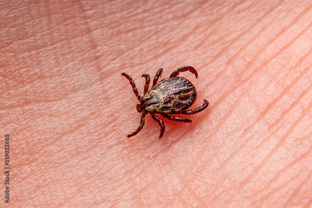 Infectious Encephalitis Tick Insect on Skin. Encephalitis Virus or Lyme ...