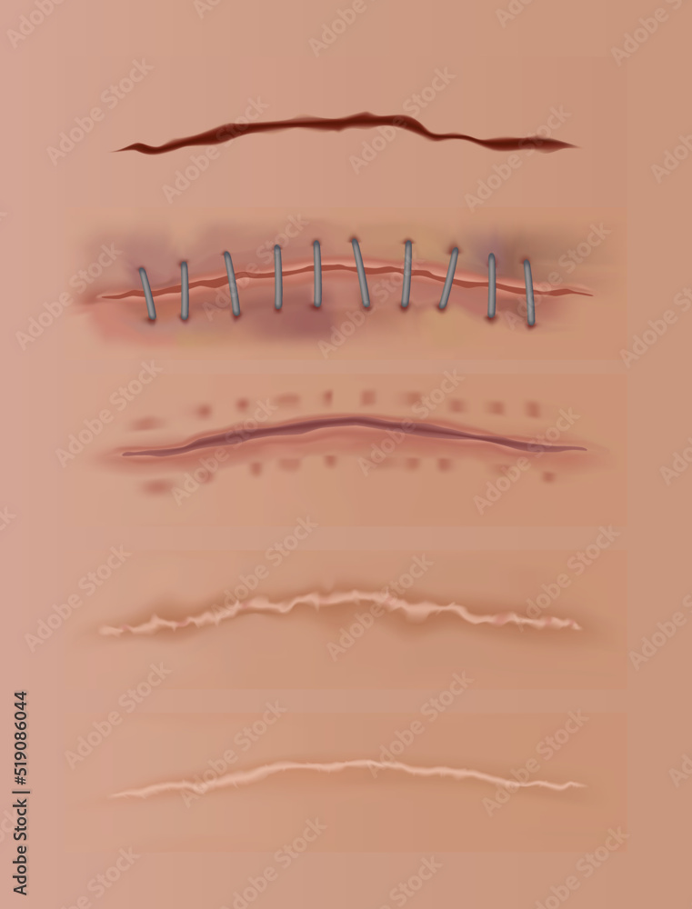 Healing wounds set, skin scars, stitched gash and cuts. Realistic ...
