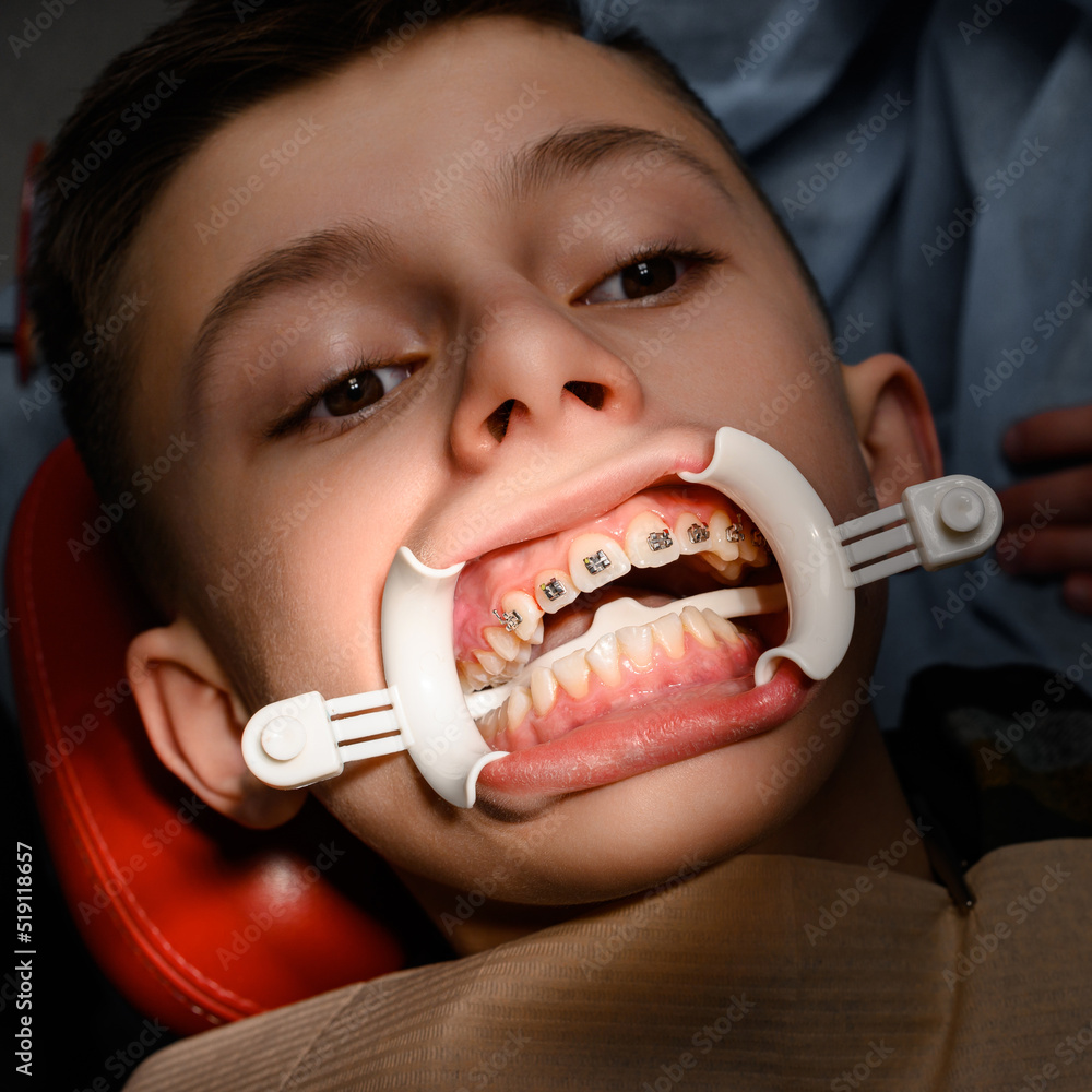 White retractor on lips and installation of metal braces on teen's ...