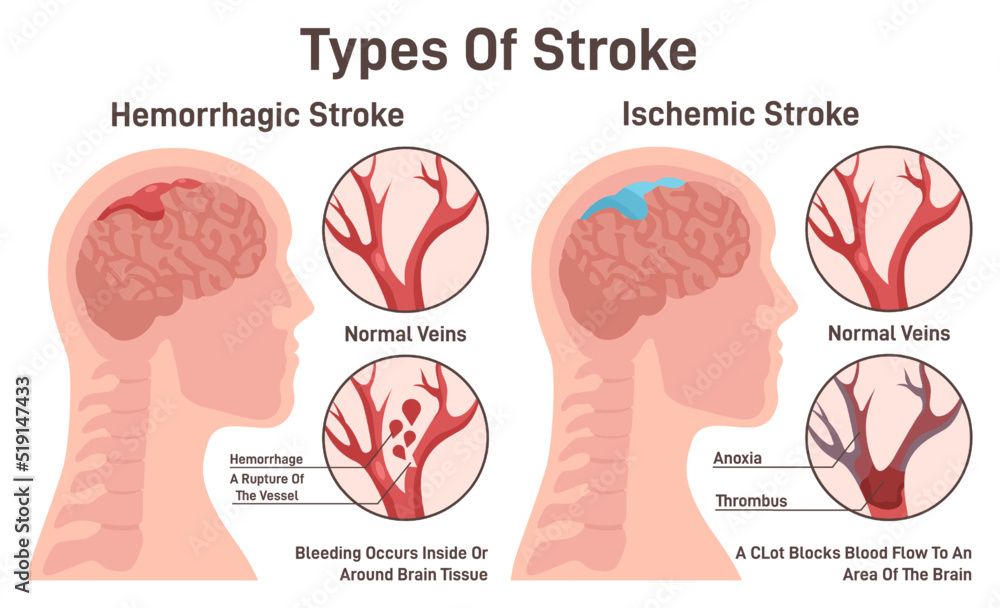 Stroke types set. Hemorrhagic and ischemic brain stroke. Damaged human Stock Vector | Adobe Stock