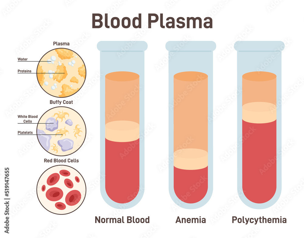 Blood plasma. Structure of normal blood, blood with anemia, obrazy ...