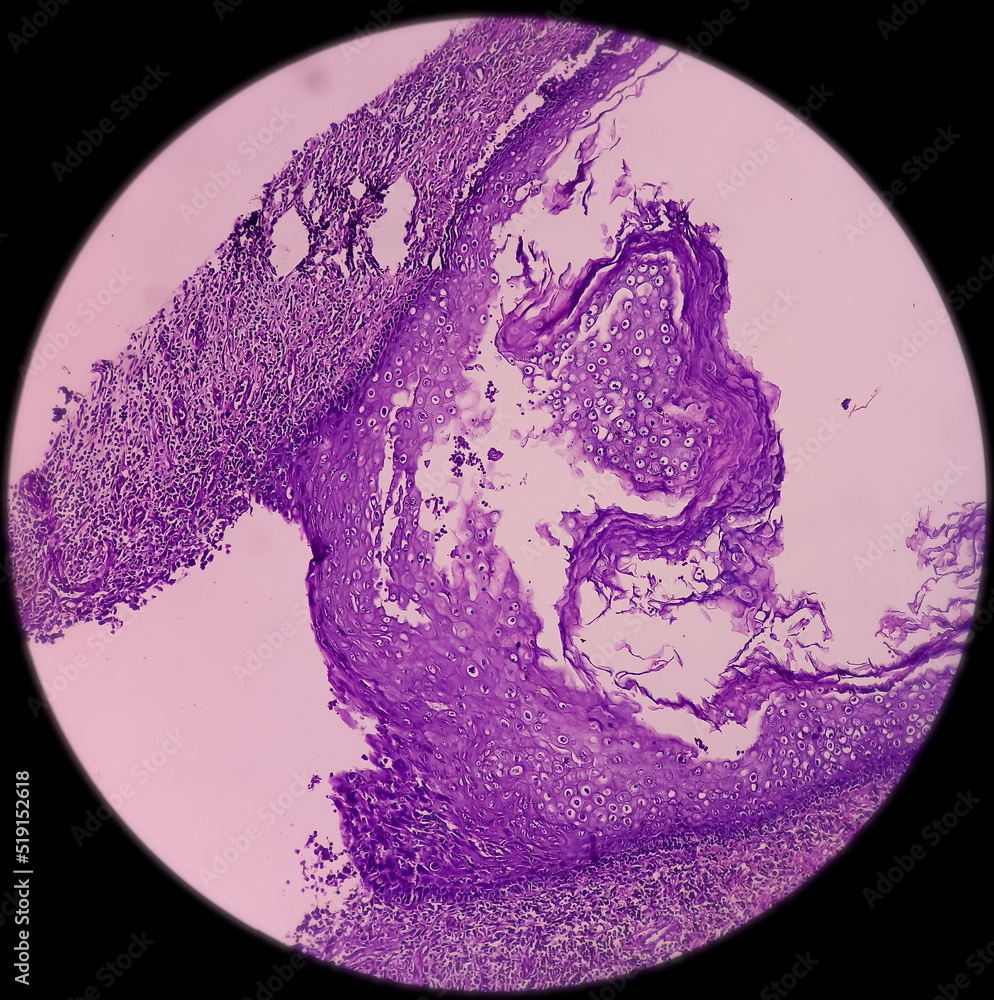 Microscopic image of neck mass cancer, Metastatic adenocarcinoma, show ...