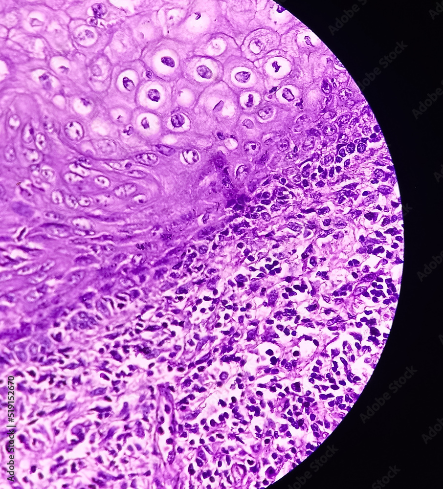 Microscopic image of neck mass cancer, Metastatic adenocarcinoma, show ...