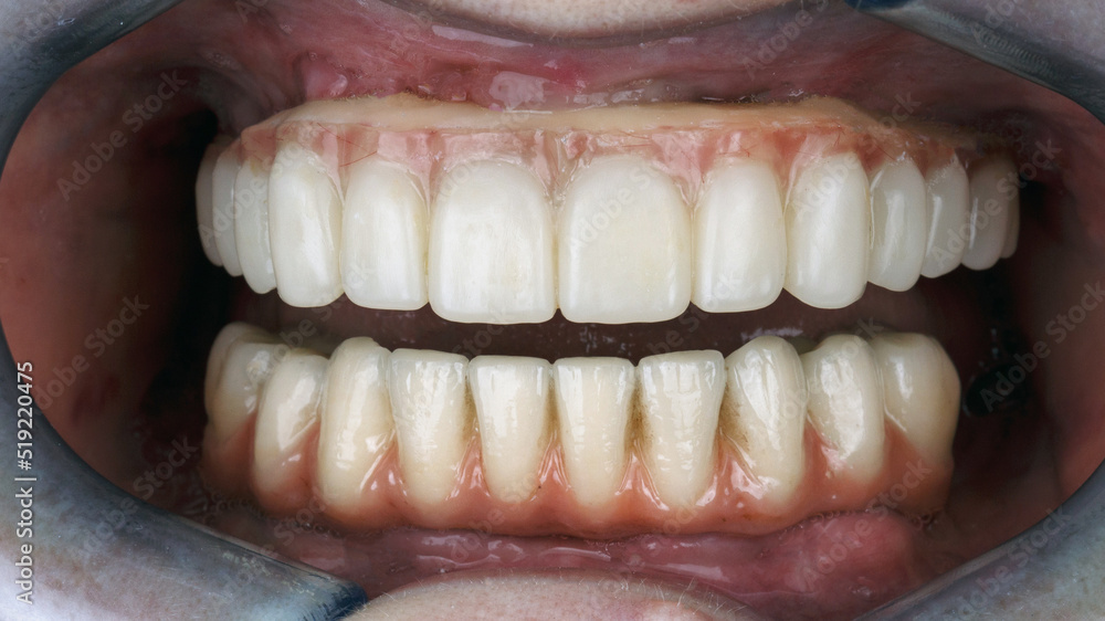 temporary dental prosthesis of the upper jaw made of polymer and ...