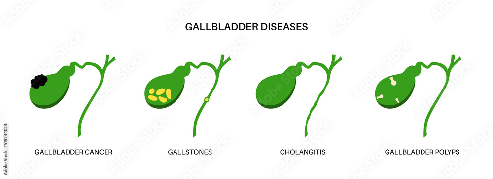 Gallbladder diseases poster Stock Vector | Adobe Stock