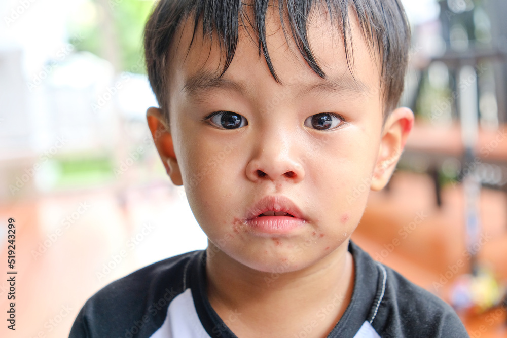 Viral Exanthem infection on Boy's face, Chicken Pox, Measles, Roseola ...