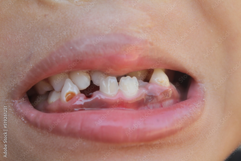 teeth in children cleft lip or cleft palate that is damaged, cavities ...