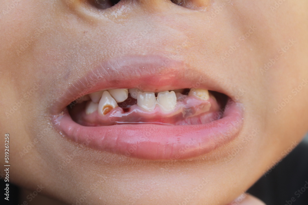teeth in children cleft lip or cleft palate that is damaged, cavities ...