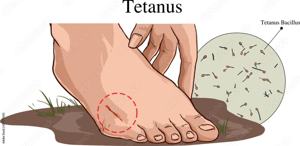 Damage to the feet. the risk of tetanus Stock Vector | Adobe Stock