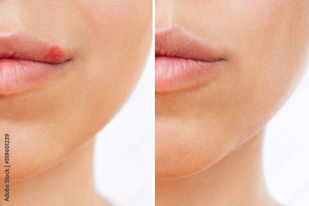 Herpes on the lip before and after treatment. Blisters caused by virus ...