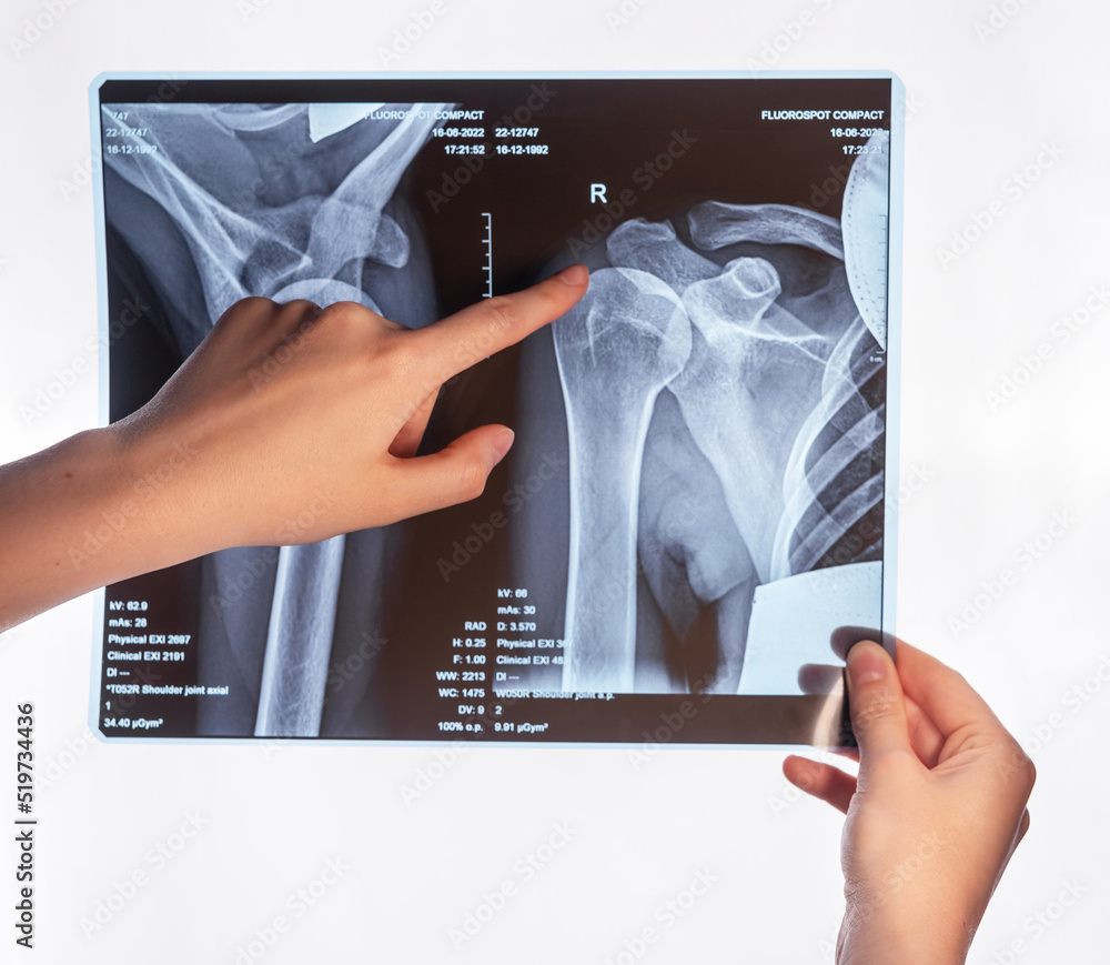 Forefinger pointing to trauma at arm X-ray image. Acromion, acromial ...