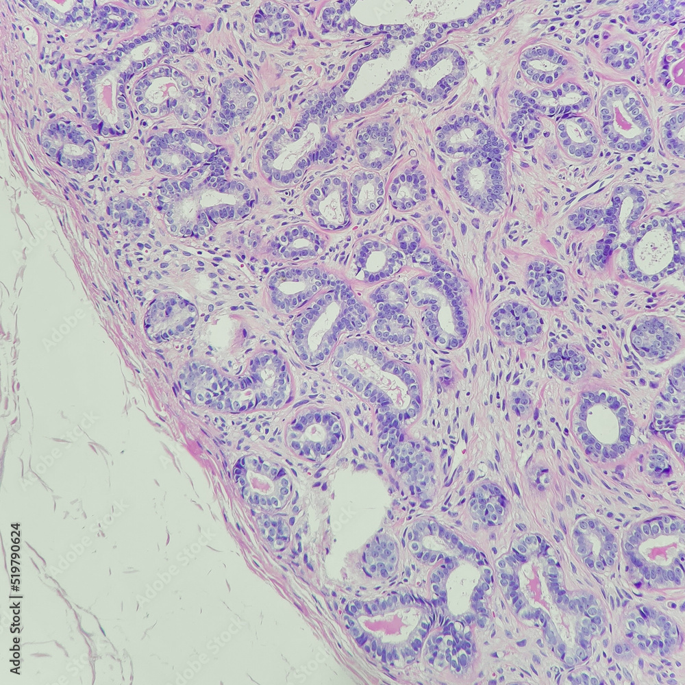 Camera photo of fibroadenoma showing well defined border with fibrous ...