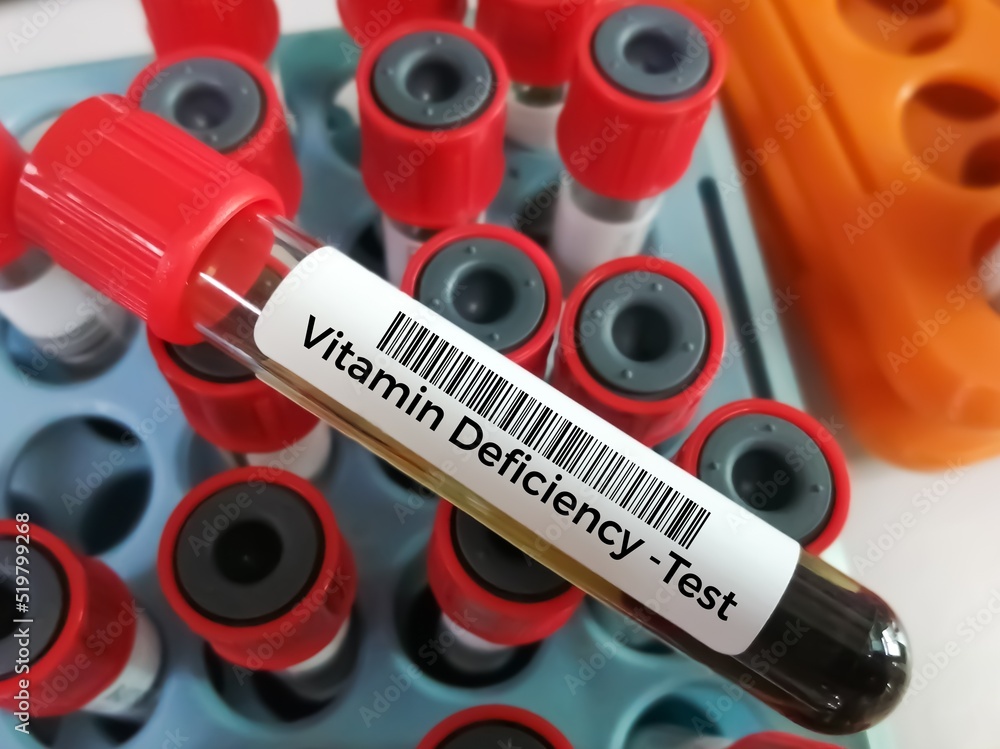 Blood sample for vitamin deficiency test. Stock Photo | Adobe Stock