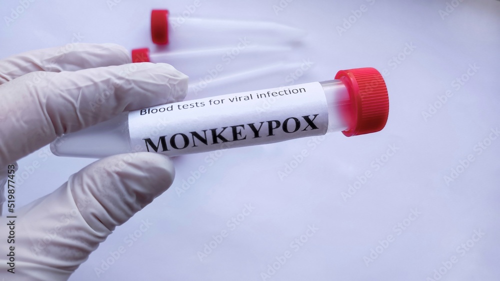 Blood sample tube for Monkeypox virus test. Monkeypox virus test tube ...