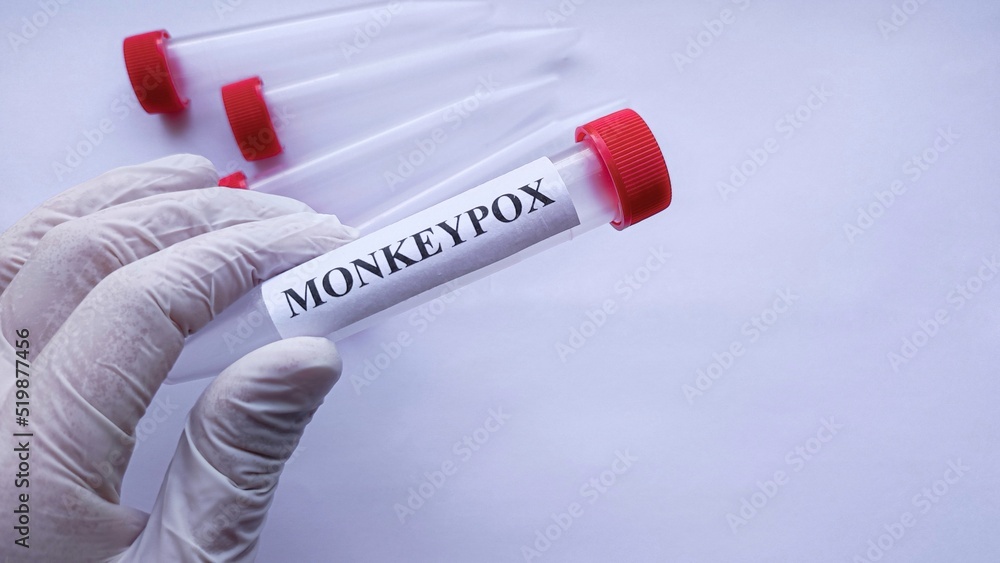 Blood sample tube for Monkeypox virus test. Monkeypox virus test tube ...