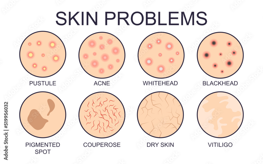 Different Types Of Skin Problems Vector Illustrations Set Signs Of