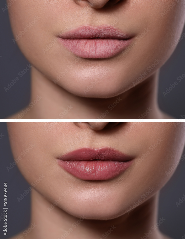 Collage with photos of woman with dry and moisturized lips, closeup ...