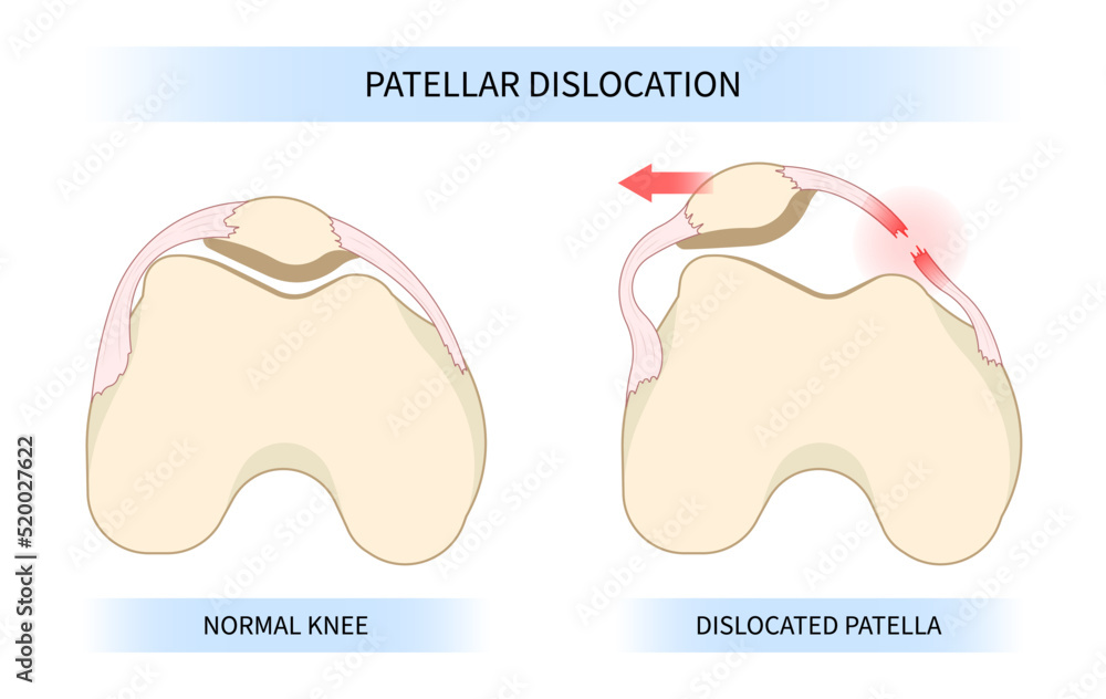 Poster The patellar dislocated and subluxation patella dysplasia with ...