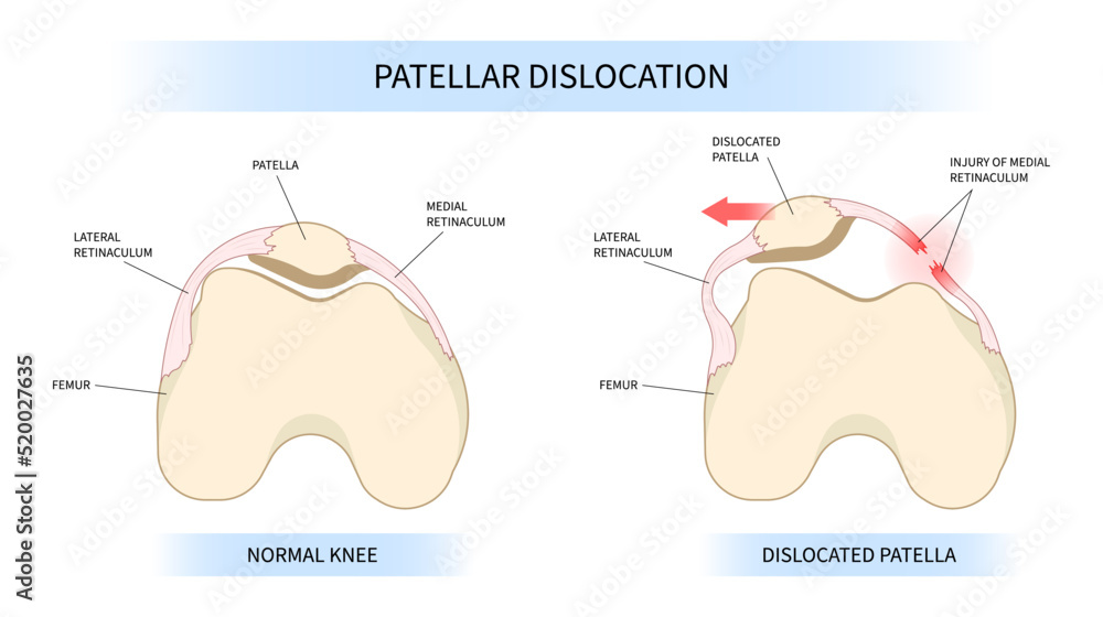 The patellar dislocated and subluxation patella dysplasia with Painful ...