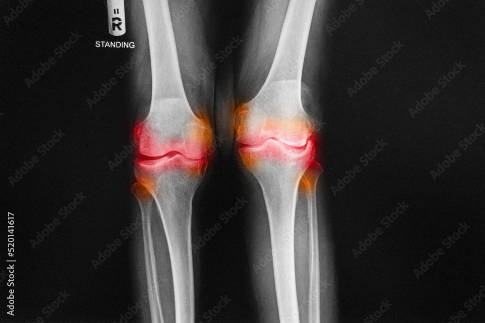 Osteoarthritis Right knee film x-ray AP (anterior - posterior) of knee ...
